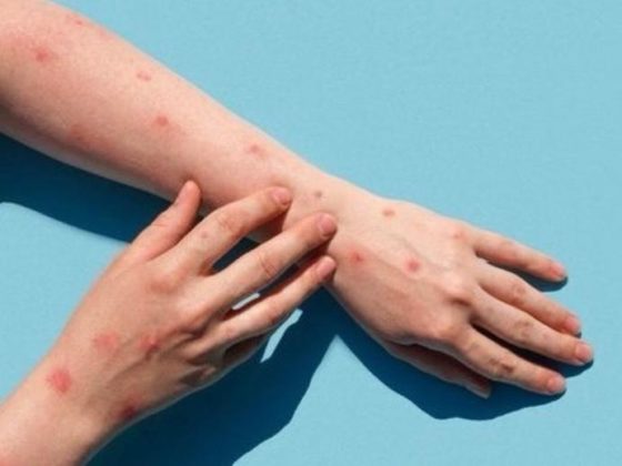 Gejala dan Pencegahan Cacar Monyet atau Monkeypox - Blog ruparupa